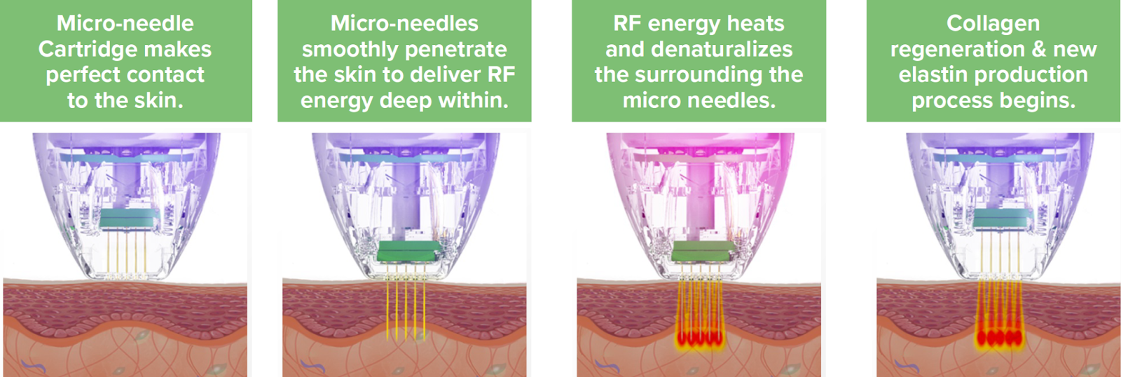 Radiofrequency Micro-needling Maitland Hunter Valley